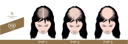 ysienie Androgenowe Typu M skiego Leczenie Wypadania W os w DSD ysienie-androgenowe-typu-m-skiego-leczenie-wypadania-w-os-w-dsd
